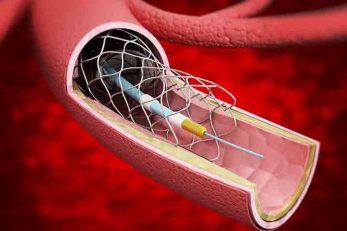 STENT NIJE UČINKOVIT? Nove spoznaje promijenit će sve što dosad znamo o ...