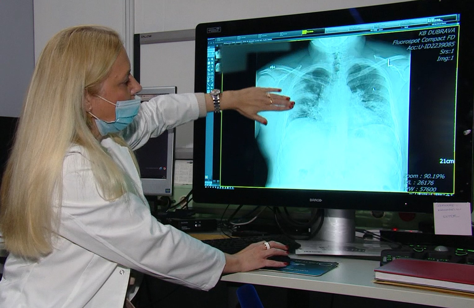 Liječnica pokazala rendgensku snimku pluća necijepljenog muškaca, na ...